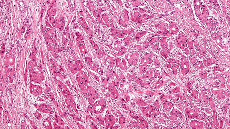 What is Fibrolamellar? - Fibrolamellar Cancer Foundation